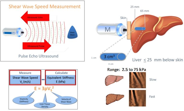 Fibroscan - Dr Douglas Samuel
